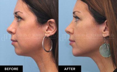 How Long Do Fillers Last? The Definitive Guide