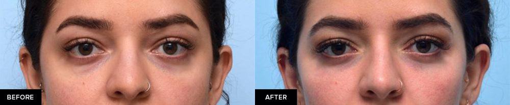 Michelle’s Full-Face Dermal Fillers Treatment | Wedding Day Prep, Part ...