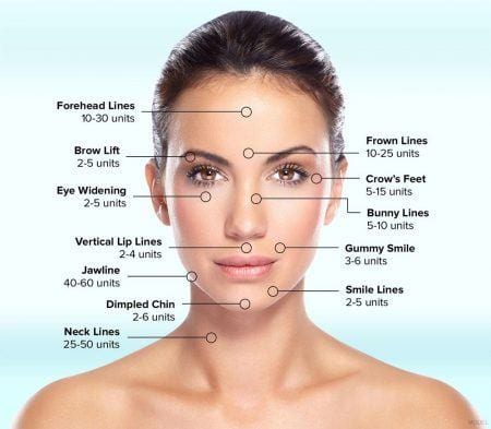BOTOX in the San Francisco Bay Area
