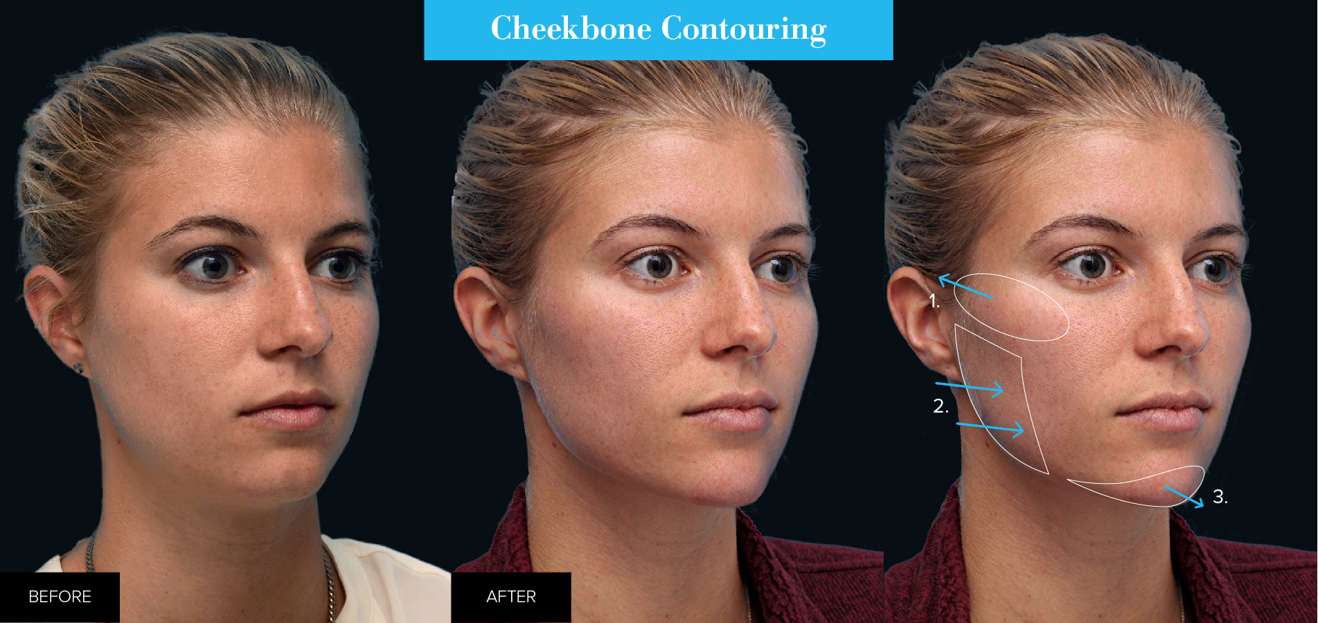 Face Slimming With BOTOX® in the San Francisco Bay Area | Dr. David ...