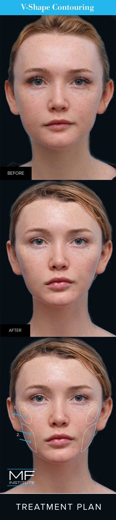 Forget Buccal Fat Removal: Start With BOTOX® for Face Slimming (Updated ...