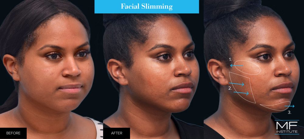 Forget Buccal Fat Removal: Start With BOTOX® for Face Slimming (Updated ...