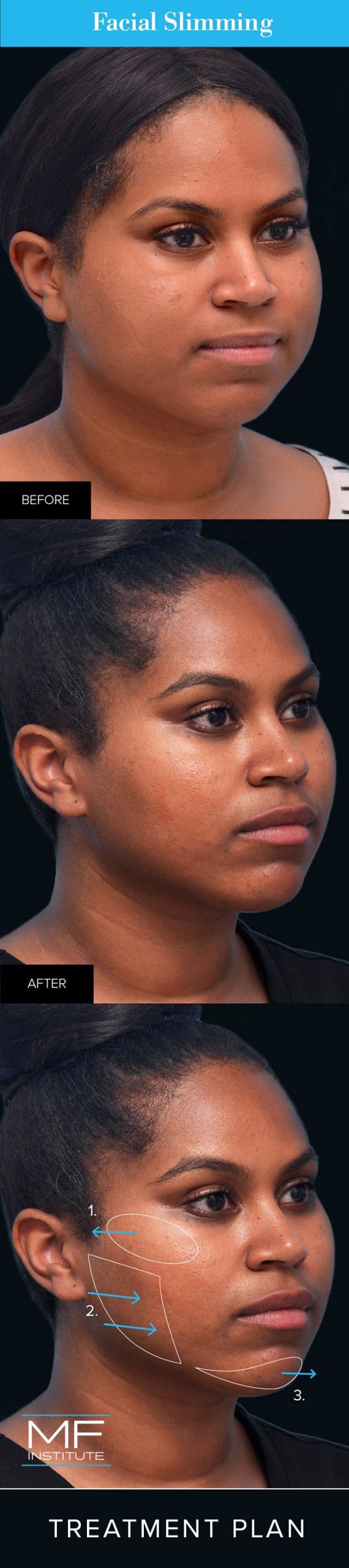 Forget Buccal Fat Removal: Start With BOTOX® for Face Slimming (Updated ...