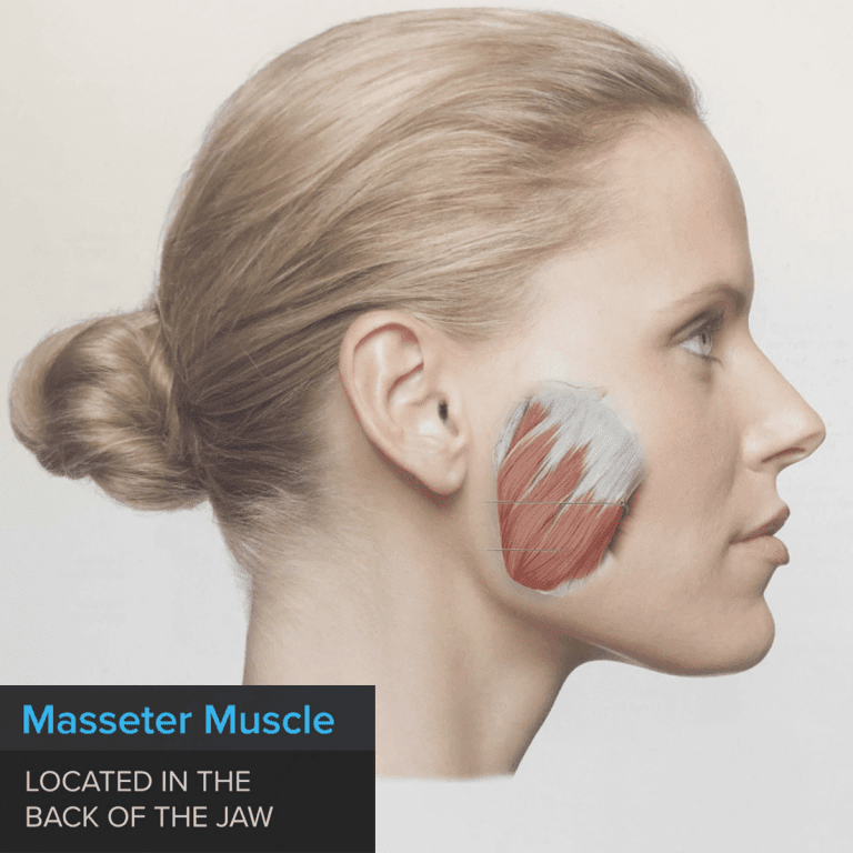 Face Slimming With BOTOX® in the San Francisco Bay Area | Dr. David Mabrie