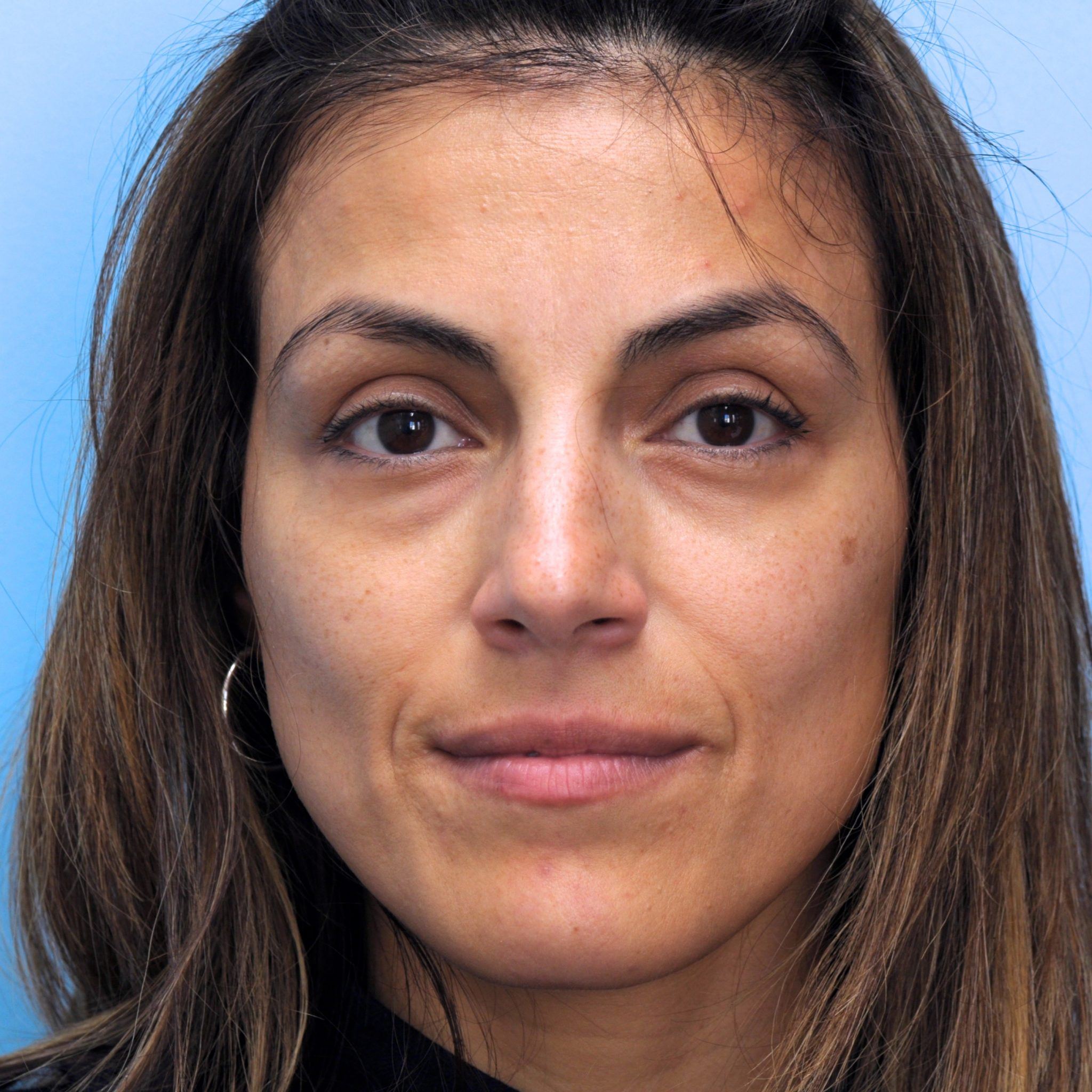 How Long Do Dermal Fillers Last? The Definitive Guide