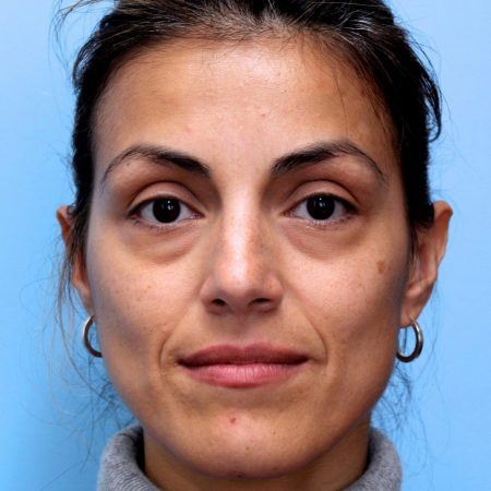 How Long Do Dermal Fillers Last? The Definitive Guide