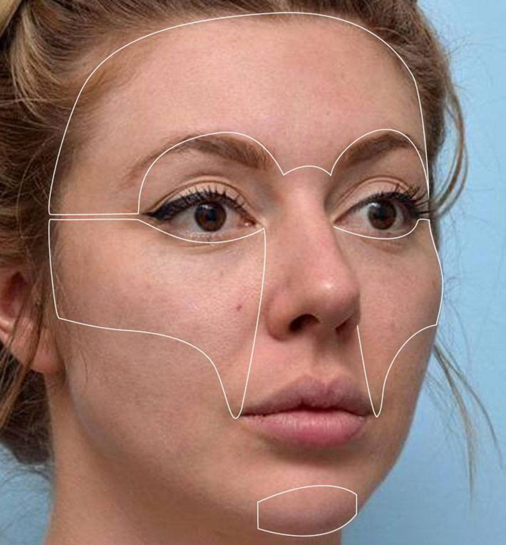 Filler for Nasolabial Folds in San Francisco – Mabrie Facial Institute