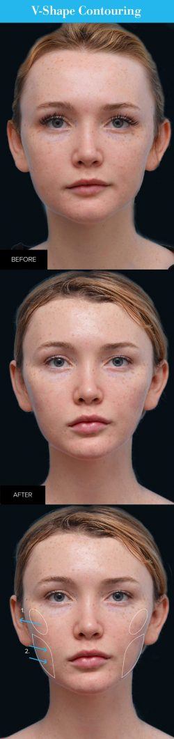 Face Slimming With BOTOX® in the San Francisco Bay Area | Dr. David Mabrie