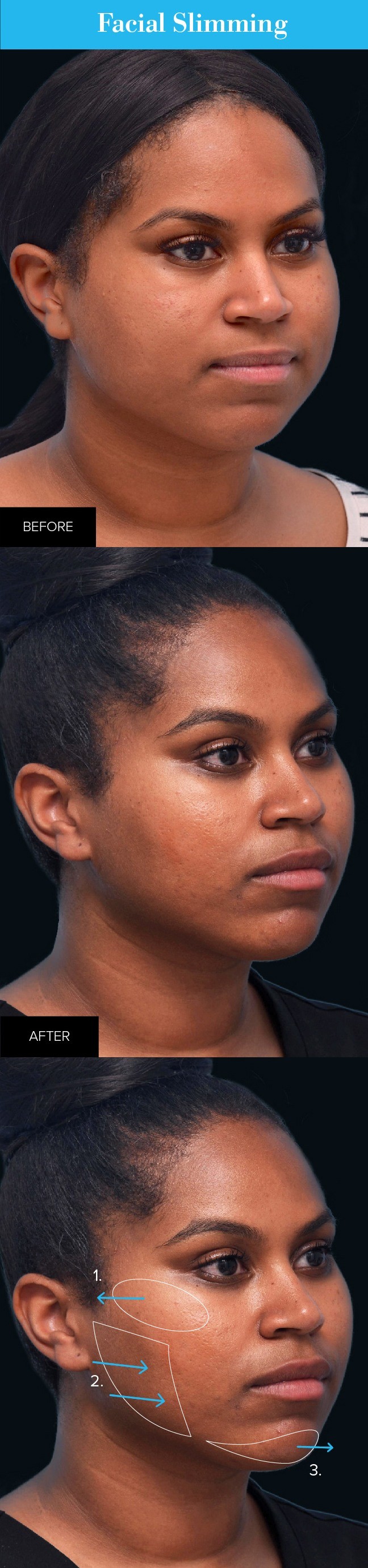 Face Slimming With BOTOX® in the San Francisco Bay Area | Dr. David Mabrie