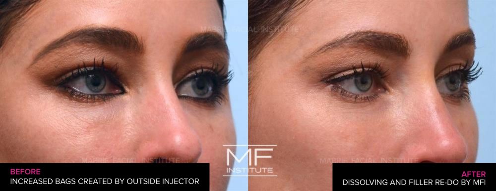 Corrective Injections Dissolving Facial Fillers With Hylenex Hyaluronidase In San Francisco