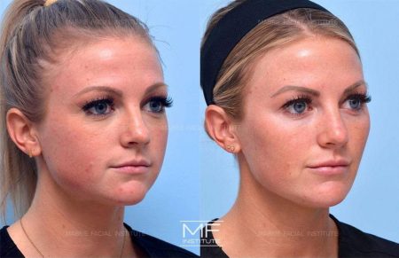 Jawline Contouring With Filler for San Francisco Bay Area