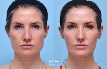 How To Get Defined/High Cheekbones With Cheek Filler in San Francisco ...