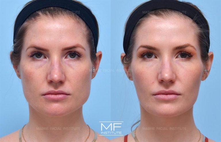 How To Get Defined/High Cheekbones With Cheek Filler in San Francisco ...