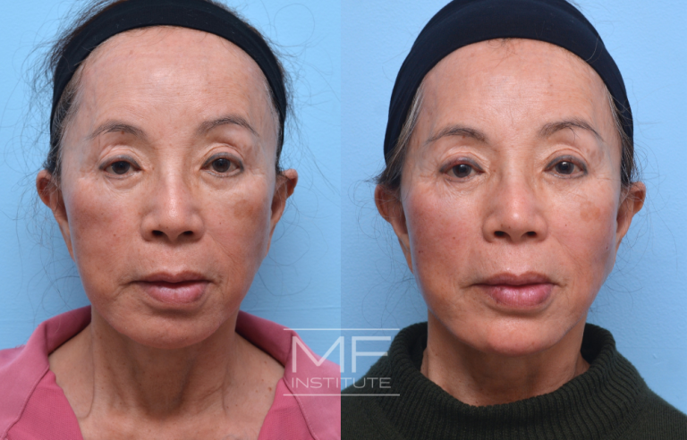 Under Eye/Tear Trough Filler: Everything You Need To Know – Mabrie ...