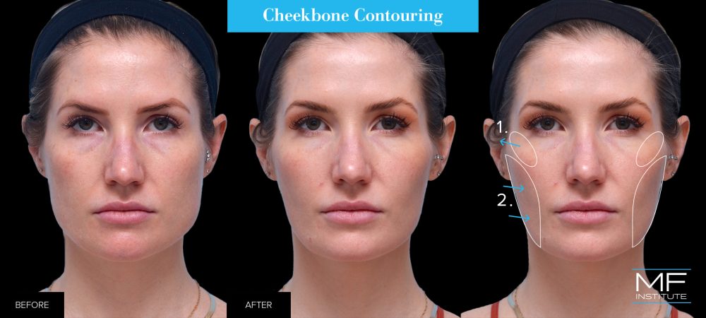 Forget Buccal Fat Removal: Start With BOTOX® for Face Slimming (Updated ...