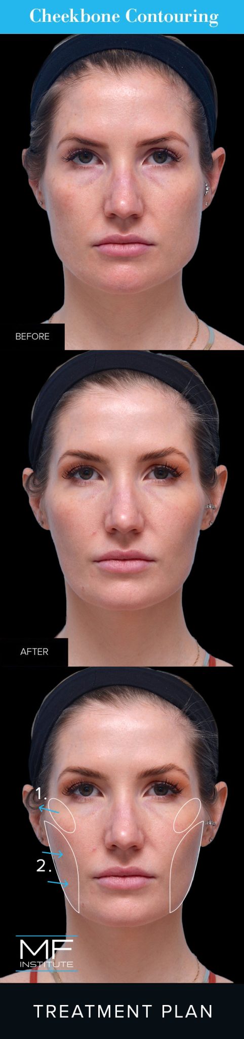 Forget Buccal Fat Removal: Start With BOTOX® for Face Slimming (Updated ...