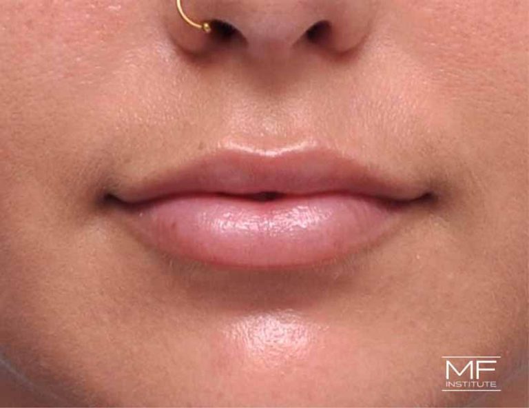 BOTOX® and Dermal Filler Before and Aftercare Instructions | Mabrie ...