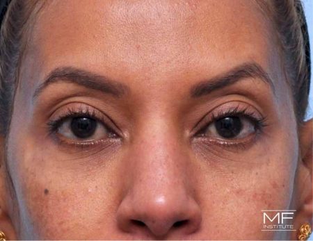 BOTOX® and Dermal Filler Before and Aftercare Instructions | Mabrie ...