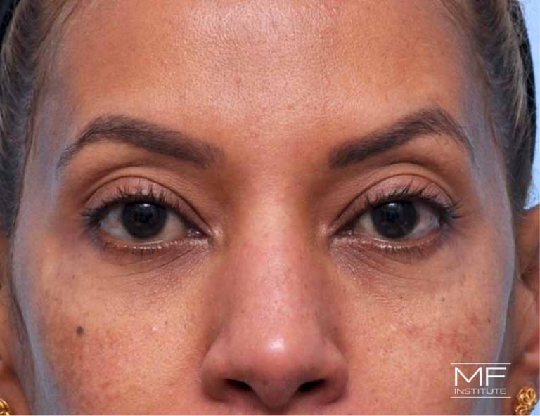 BOTOX® and Dermal Filler Before and Aftercare Instructions | Mabrie ...