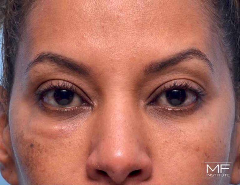 BOTOX® and Dermal Filler Before and Aftercare Instructions | Mabrie ...