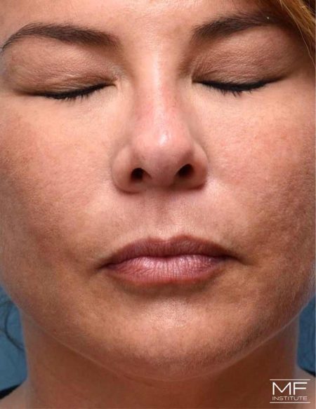 BOTOX® and Dermal Filler Before and Aftercare Instructions | Mabrie ...