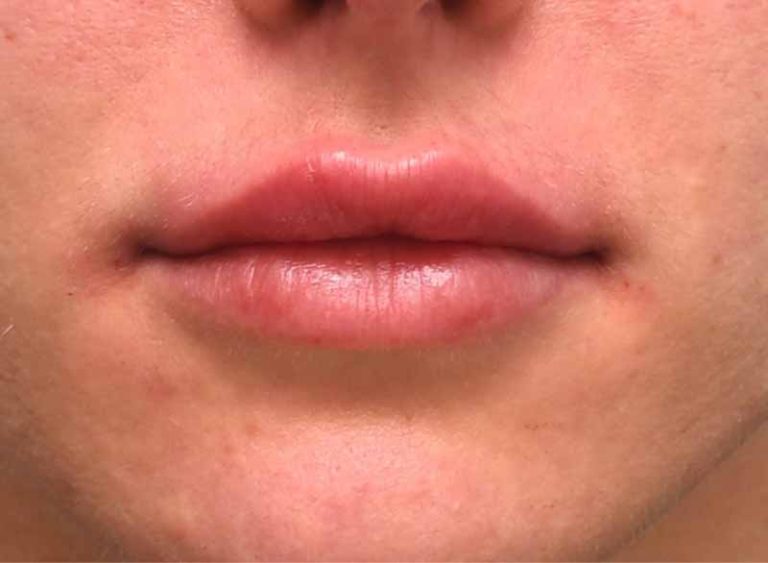 BOTOX® and Dermal Filler Before and Aftercare Instructions | Mabrie ...