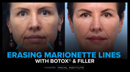 Before and After Marionette Lines Filler: A Photo FAQ | Mabrie Facial ...