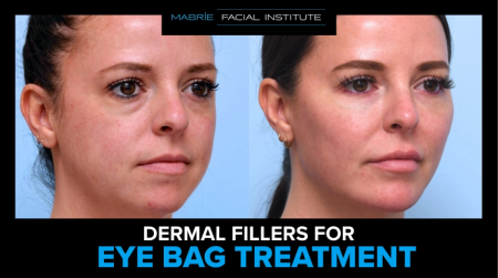 Under Eye/Tear Trough Filler: Everything You Need To Know – Mabrie ...