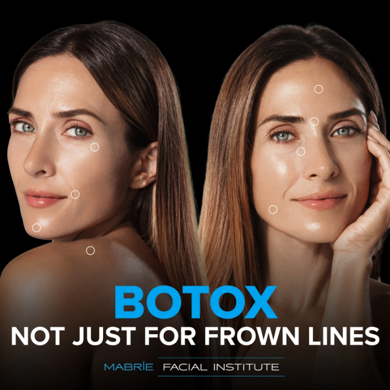 Beyond Wrinkles: Discover Surprising Benefits of BOTOX® for Trap ...