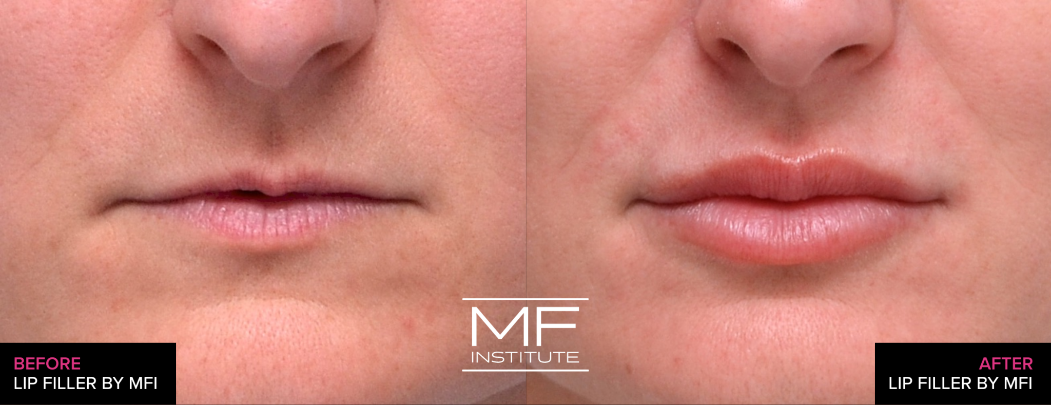 How Much Does Lip Filler Cost in San Francisco? – Mabrie Facial Institute