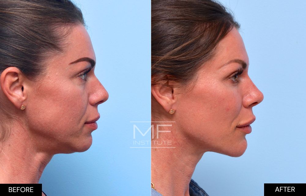 Chin & Jawline Fillers & BOTOX: A Guide to Facial Contouring for ...