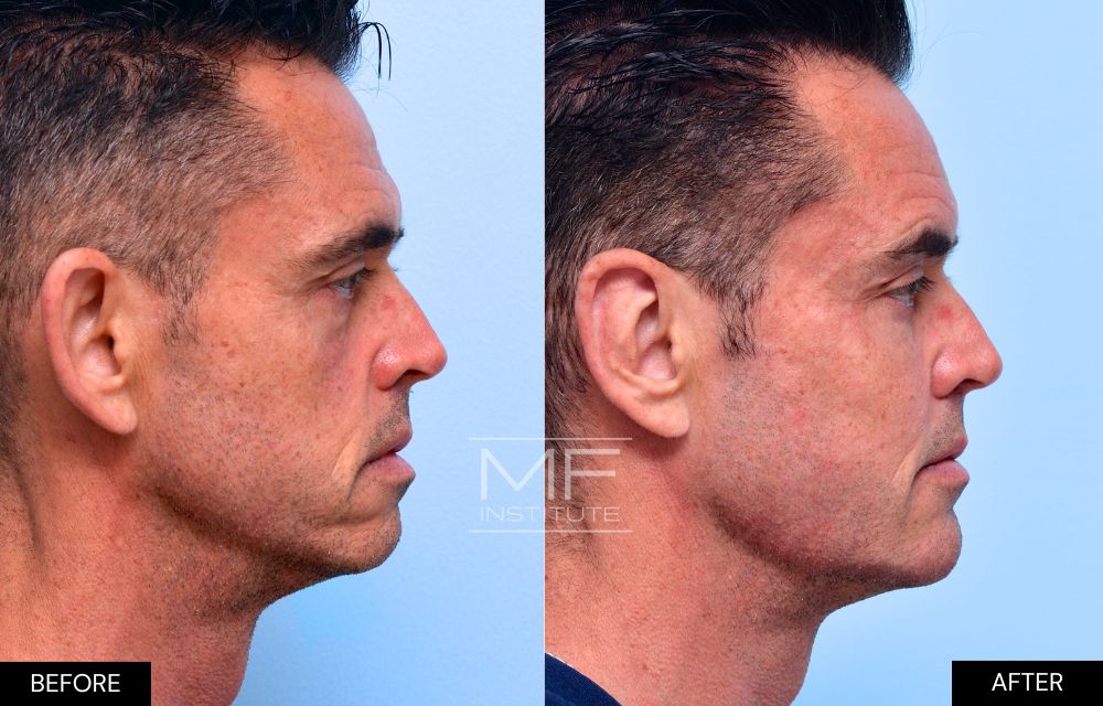Chin & Jawline Fillers & BOTOX: A Guide to Facial Contouring for ...