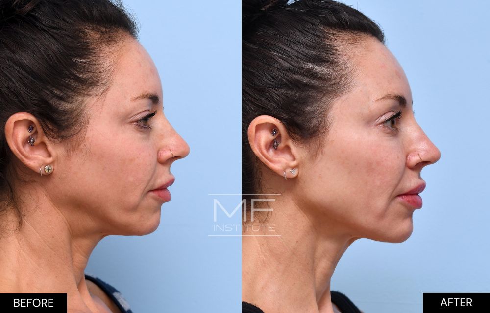 Chin & Jawline Fillers & BOTOX: A Guide to Facial Contouring for ...