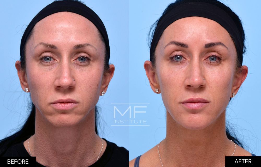 Chin & Jawline Fillers & BOTOX: A Guide to Facial Contouring for ...