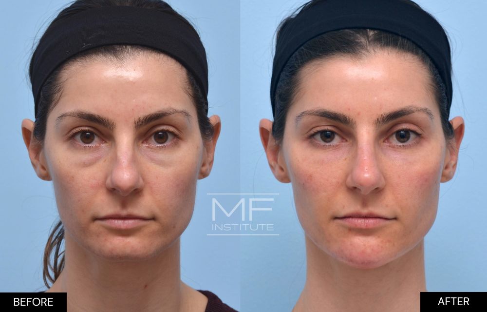 Chin & Jawline Fillers & BOTOX: A Guide to Facial Contouring for ...