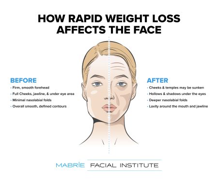 How Fillers Shape Your Best Face Before and After Weight Loss – Mabrie ...