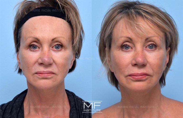 What’s the Best Treatment for Deep Wrinkles on the Face? – Mabrie ...
