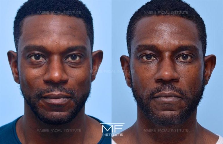 Looksmaxxing Tips: How To Get Rid of Bags Under the Eyes for Men ...