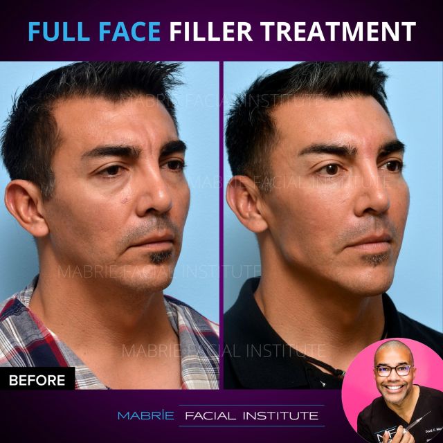 Non surgical Facial Rejuvenation & Contouring With Fillers in San ...
