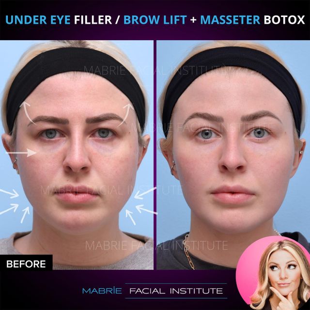 Non surgical Facial Rejuvenation & Contouring With Fillers in San ...